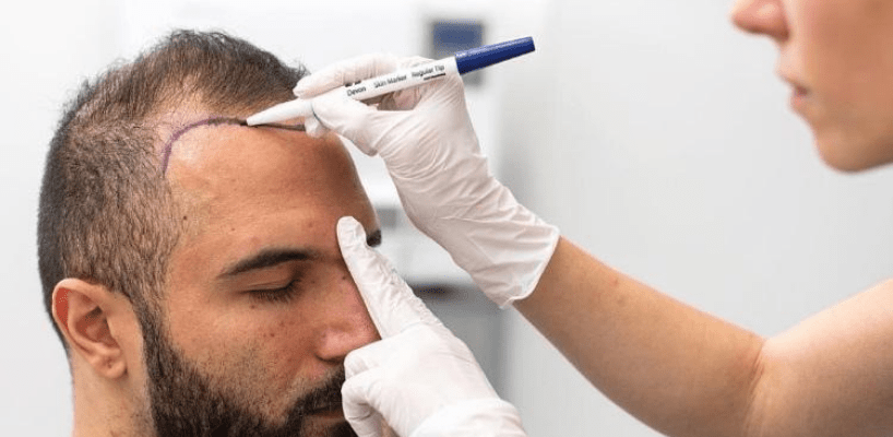 Why More Men Are Having Hair Transplants In Turkey Greis Anatomy